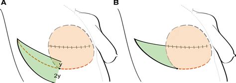 The Pedicled Licap Flap Combined With A Free Abdominal Flap