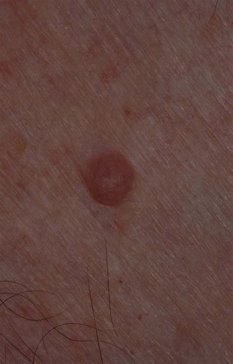 Cutaneous Neurofibromas
