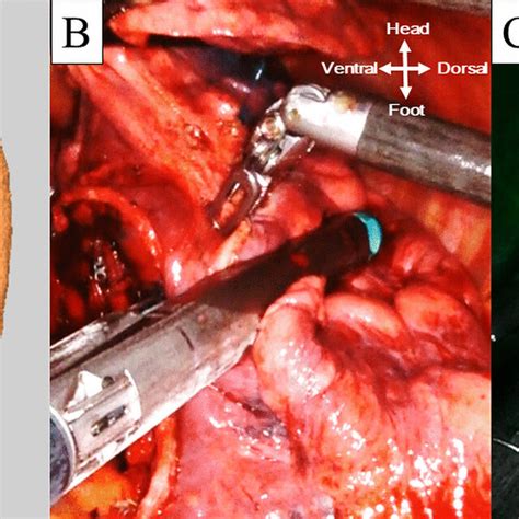 Division Of Interlobar Fissure And Intersegmental Plane A Image Of Download Scientific Diagram