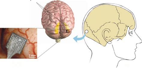 4 overview of the implantation procedure of the electrode array near