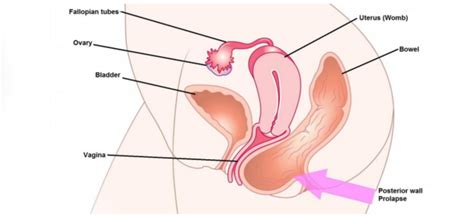 Pelvic Organ Prolapse Pop Cuh