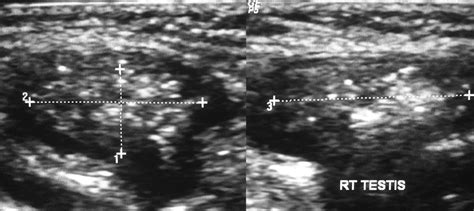 Ultrasonography Image Demonstrating Multiple Foci Of Calcifications