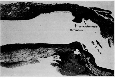 Figure 4 From Early Thrombogenesis After Aortic Anastomosis By