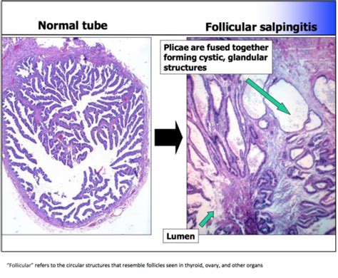 Sti And Pid Flashcards Quizlet