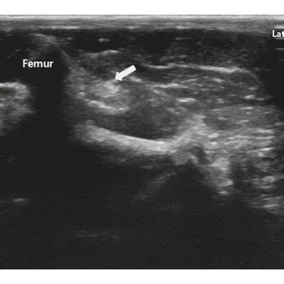 Ultrasound Image Of Sciatic Nerve Arrow Download Scientific Diagram