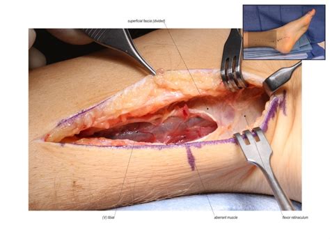 Tarsal Tunnel Release Surgical Education Learn Surgery Washington
