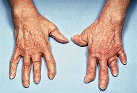What Psoriatic Arthritis Does To Your Body Explained