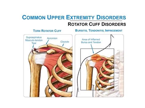 Disorders Of Upper Limb Odp