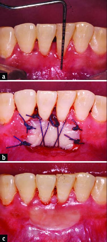 A Class I Gingival Recession Defect With 31 41 B Free Gingival Download Scientific