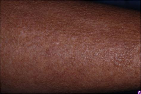 Lichen Amyloidosis Lichen Amyloidosus Papular Amyloidosis Lichenoid