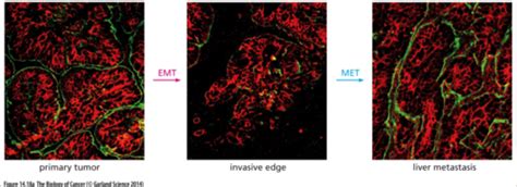 Metastasis Flashcards Quizlet