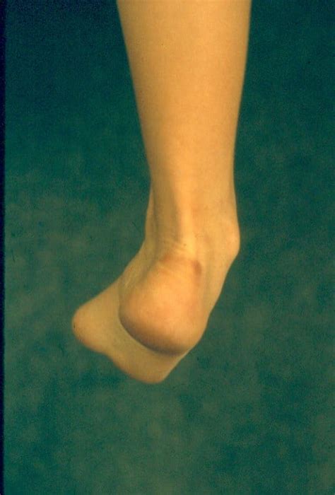 Revisiting Supination Vs Pronation Vionic