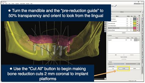 Ten Steps To Bone Reduction In A Full Arch Surgical Guide Dentistry Today