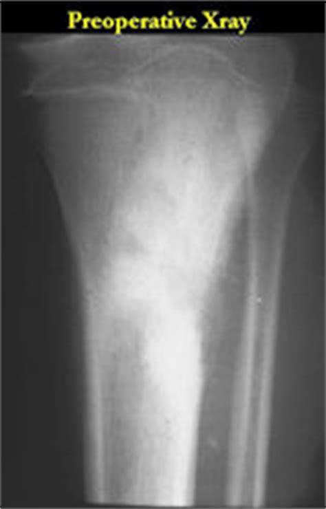 Osteosarcoma Conventional Bone Tumor Cancer