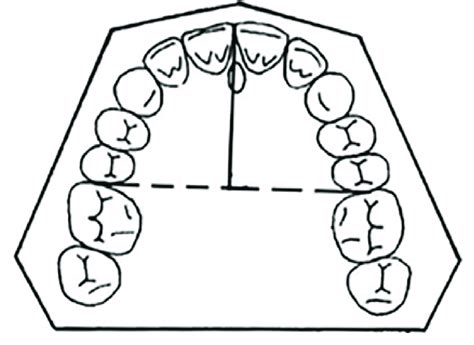 Palatal Length The Length Of A Virtual Perpendicular Line Constructed Download Scientific