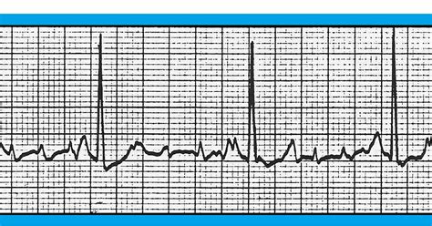 ECG Interpretation ECG Blog Atrial Flutter AV Block Artifact Sinus Rhythm