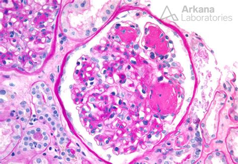 Nodular Glomerulosclerosis Pas Ismms Nephrology Fellowship