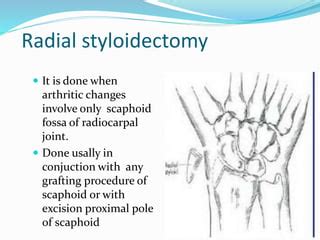 Avascular Necrosis Of Scaphoid Pptx