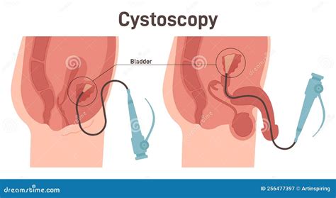 Cystoscopy Set Male And Female Bladder Surface Examination With A Flexible Stock Vector