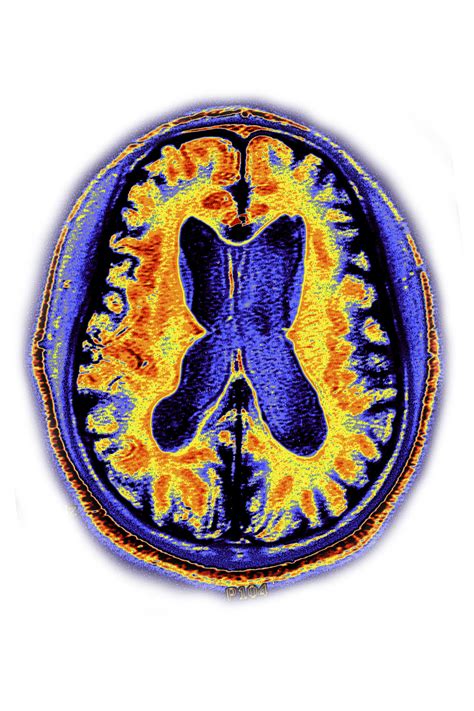 Why Should You Have A Brain Scan To Test For Dementia When Theres No