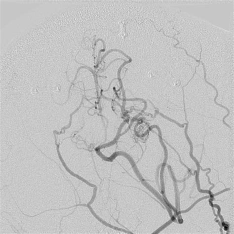 Sta Moyamoya Mca Artery Anastomosis Disease Superficial Temporal Flow