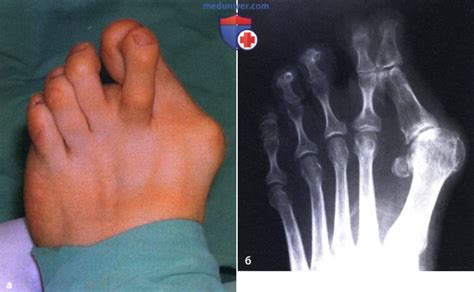 Приобретенная вальгусная деформация первого пальца (hallux valgus ...