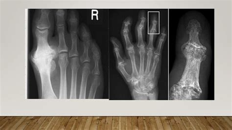 common bone pathologies esp arthrit pptx bone and joint conditions