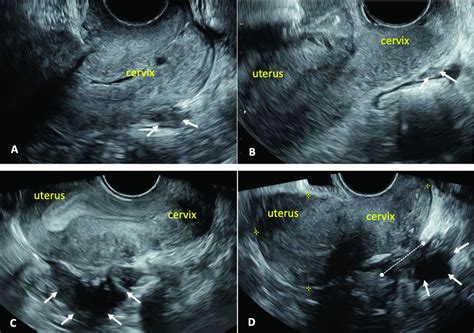 Endometriosis Uterus Ultrasound