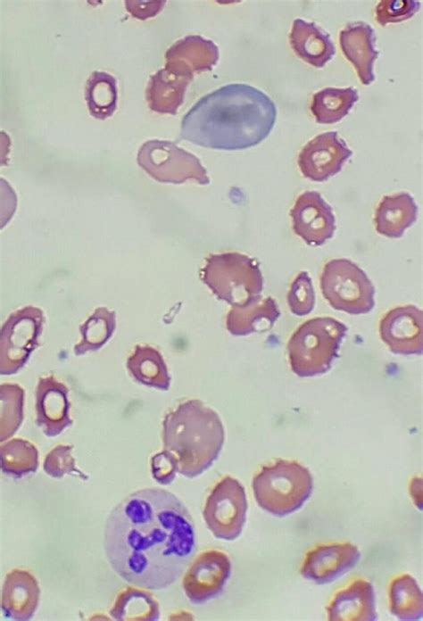 Policromatofilia Ou Reticulócitos Hemoclass Hematologia E Medicina