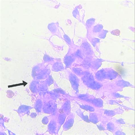 Cytology Smear From Lymphnode Showing Cluster Of Malignant Squamoid Download Scientific Diagram