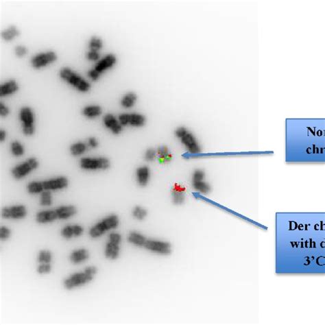Acute Myeloid Leukemia Karyotypes Involving Abnormalities In The Cbfb Download Scientific