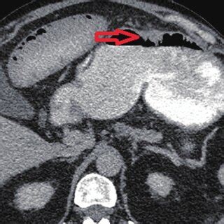 Contrast Based CT Scan Of The Abdomen With A Gastric Mass In The Download Scientific Diagram