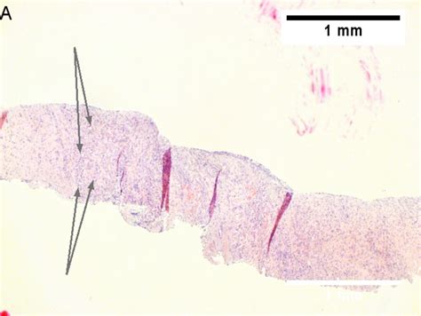 Cholangiocarcinoma Libre Pathology