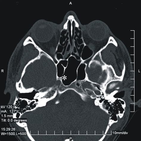 Pdf The Anatomical Relations Of The Sphenoid Sinus And Their