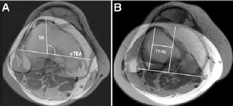 Figure 3 From Tibial Tuberosity Rotation In Patients With Patellar Instability Versus Age And Figure 3 From Tibial Tuberosity Rotation In Patients With Patellar Instability Versus Age And
