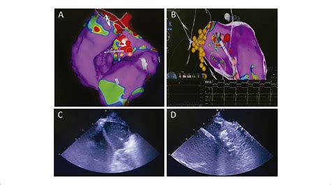 Septal Ablation With Radiofrequency And The Use Of New Technologies In Patients With