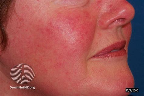 Understanding Rosacea Thegoodskinplace