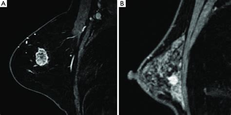 Examples Of Mri Images In Two Breast Cancer Patients A View Of A