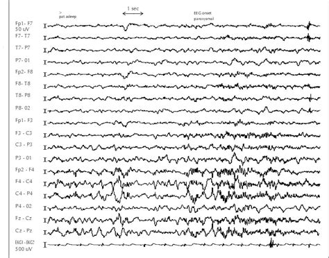 Jle Epileptic Disorders Frontal Lobe Epilepsy