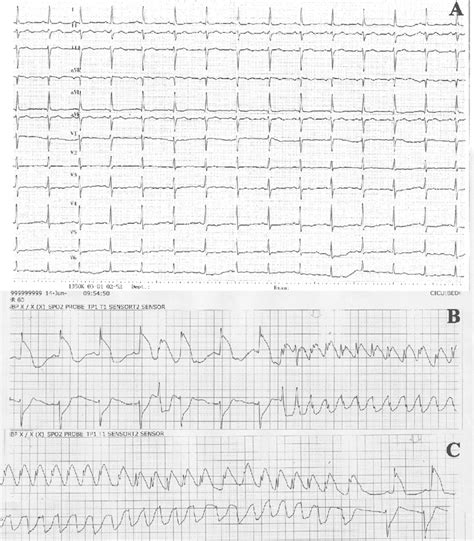 A Resting 12 Lead Ecg On Admission B Rhythm Strip Showing Transient Download Scientific