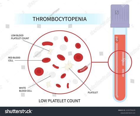 Decreased Complete Low Platelet Count Reddish Stock Vector Royalty Free 2193759145 Shutterstock