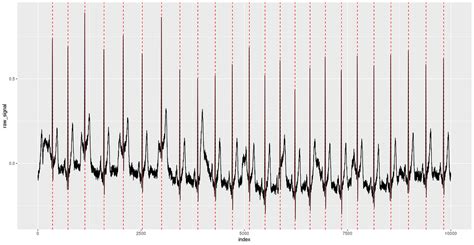 Electrocardiogram Qrs Detection Using Pan Tompkins Algorithm And R
