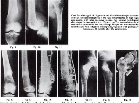 Figure 29 From Local Recurrence After Amputation For Osteosarcoma Semantic Scholar
