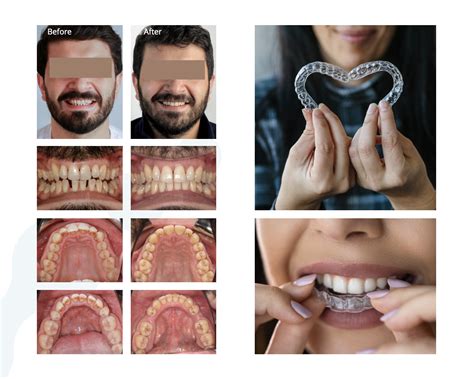 Clear Aligners Everything You Need To Know Dentalprof