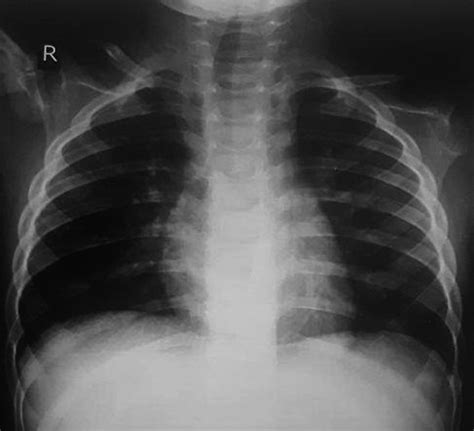 The Cxr Image Of The Patient Revealed Normal Scene Without Remarkable