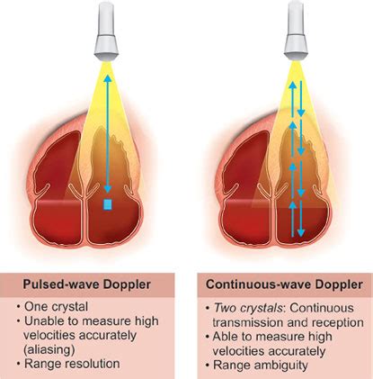Pulsed Wave Doppler