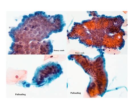 Glandular Lesions Cytology In Cervical Cytology Pdf