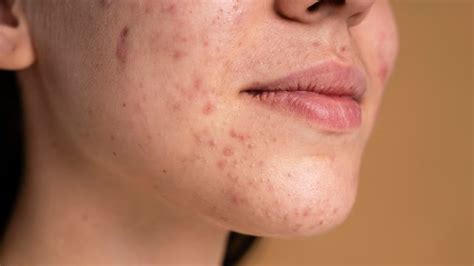 Why You Shouldn T Pick On Scabs OnlyMyHealth