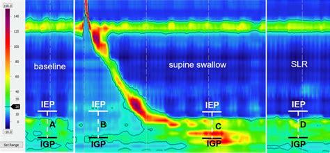 Figure 1 From Proximal Gastric Pressurization After Sleeve Gastrectomy Associates With
