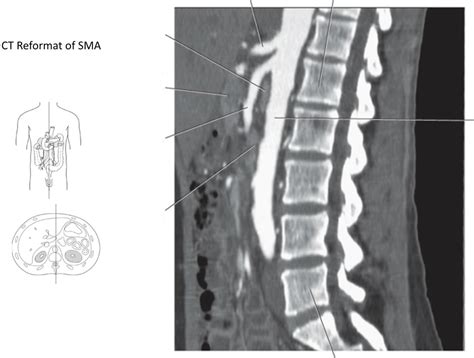 Ct Reformat Of Sma Diagram Quizlet